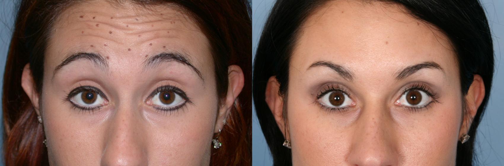 BOTOX® Cosmetic Before and After Pictures Case 57 | Naples and Ft ...