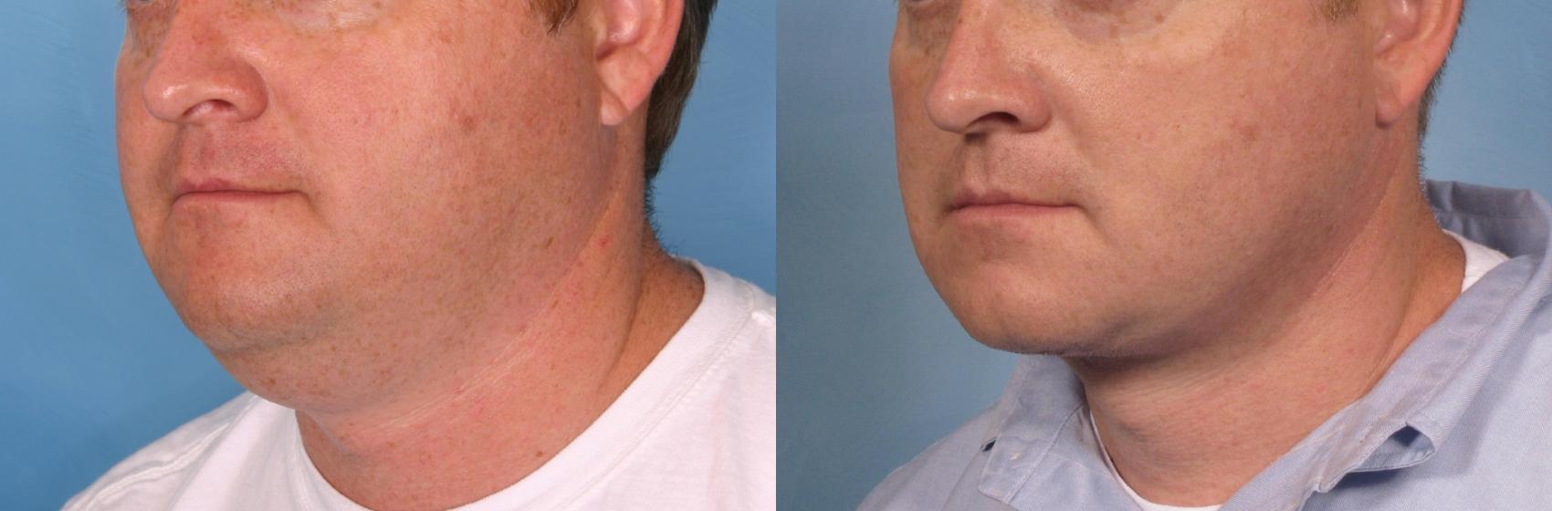 Male Face/Neck Lift Before and After Pictures Case 108 | Naples and Ft ...