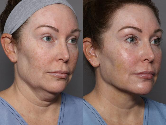 Renuvion Lower Face and Neck Lift Before and After Photo Gallery ...