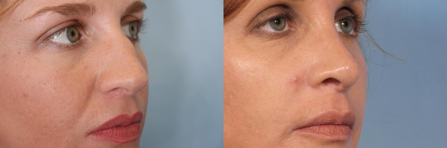 Rhinoplasty (Nose Reshaping) Before and After Pictures Case 128 ...