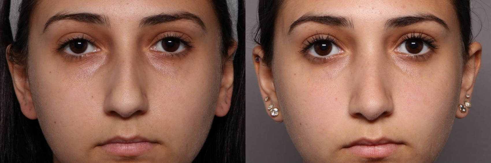 Rhinoplasty (Nose Reshaping) Before and After Photos of Young Woman in ...