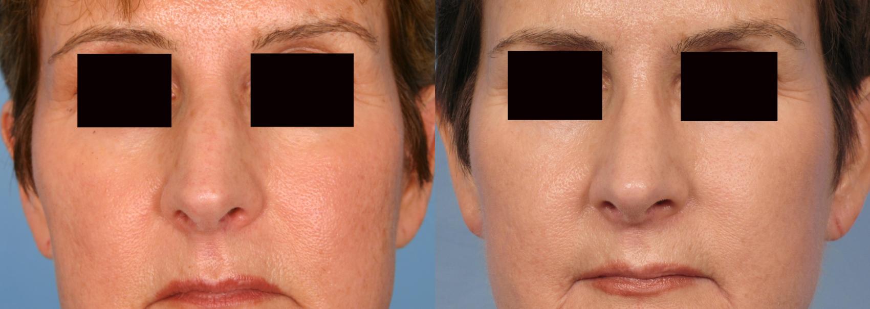 Rhinoplasty (Nose Reshaping) Before and After Pictures Case 78 | Naples ...